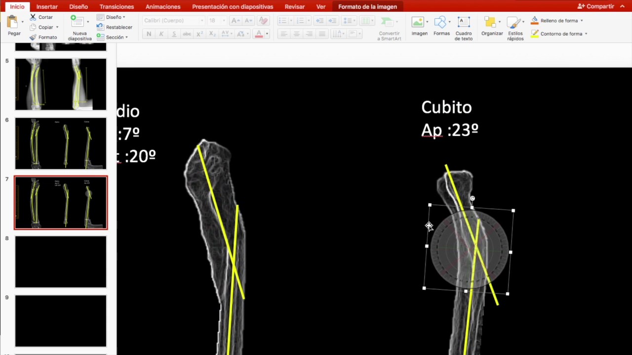 corrective osteotomy pre-operative planning on powerpoint (The Cabrera Method)