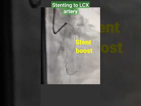 Stenting of LCX coronary artery l Heart attack #angioplasty #shorts