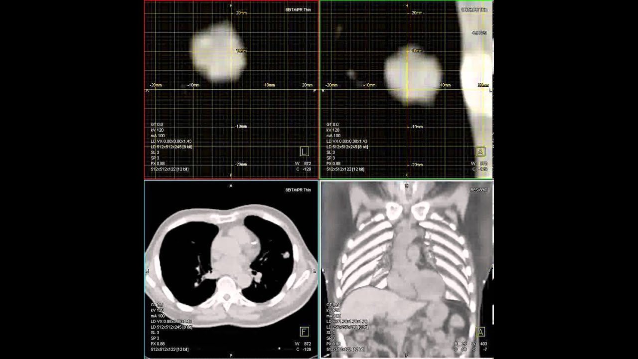 Moving lung tumor during imaging (radiation therapy)