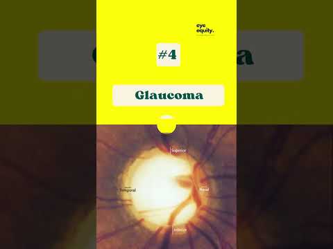 Top 5 eye diseases causing blindness | Optometry | #shorts #eye disorders