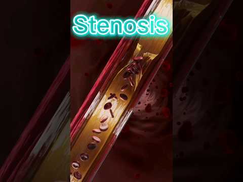 STENOSIS - MEDICAL DEFINITION | Medical Consecutive Interpreting