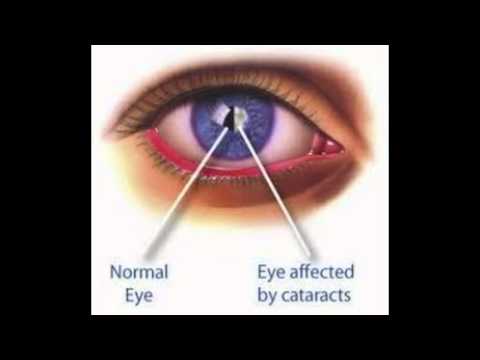 Cataract Surgery Recovery