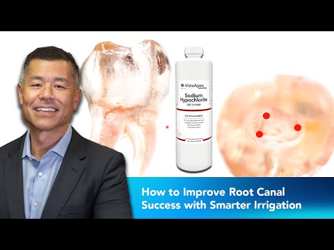 How to Improve Root Canal Success with Smarter Irrigation | Dentist 2 Dentist