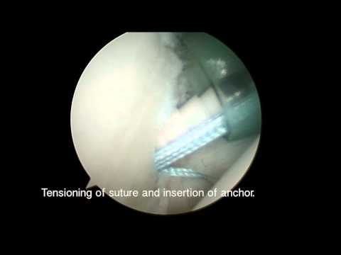 Arthroscopic Anterior Labrum Repair - Orthopedic Surgeon in New York City, Dr Howard J. Levy