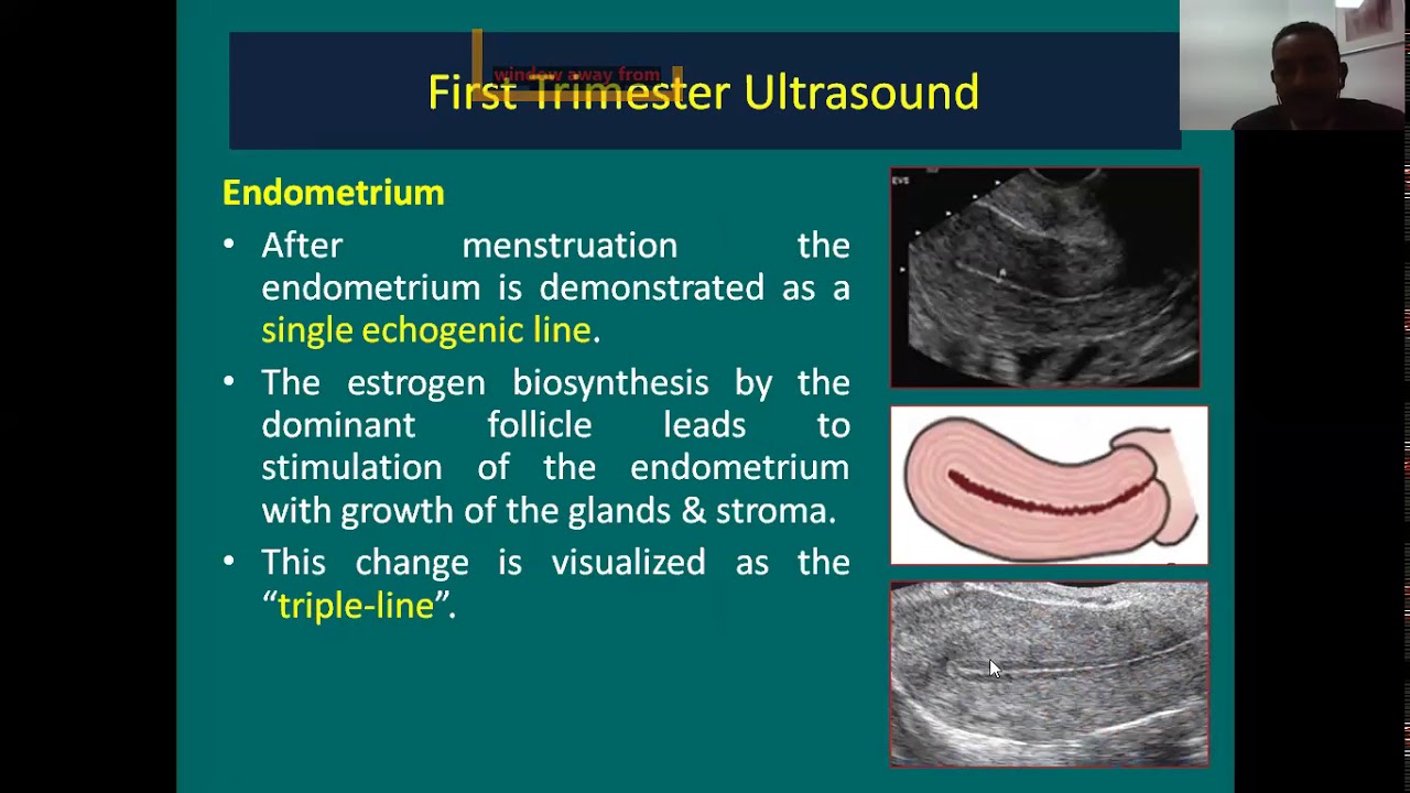 ULTRASOUND OF NORMAL FIRST TRIMESTER
