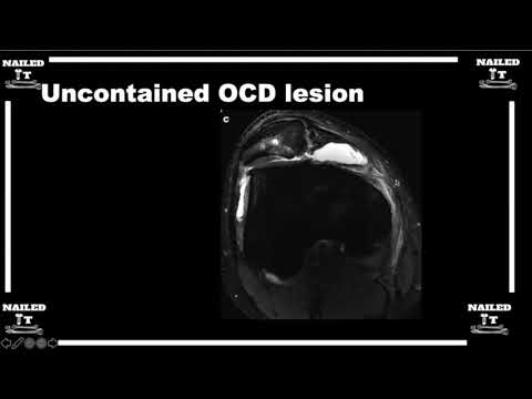 Knee Chondral Lesions on MRI w/ Dr. Saltzman