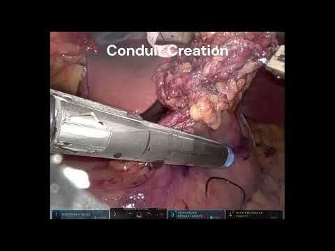 Robotic Ivor Lewis Oesophagectomy