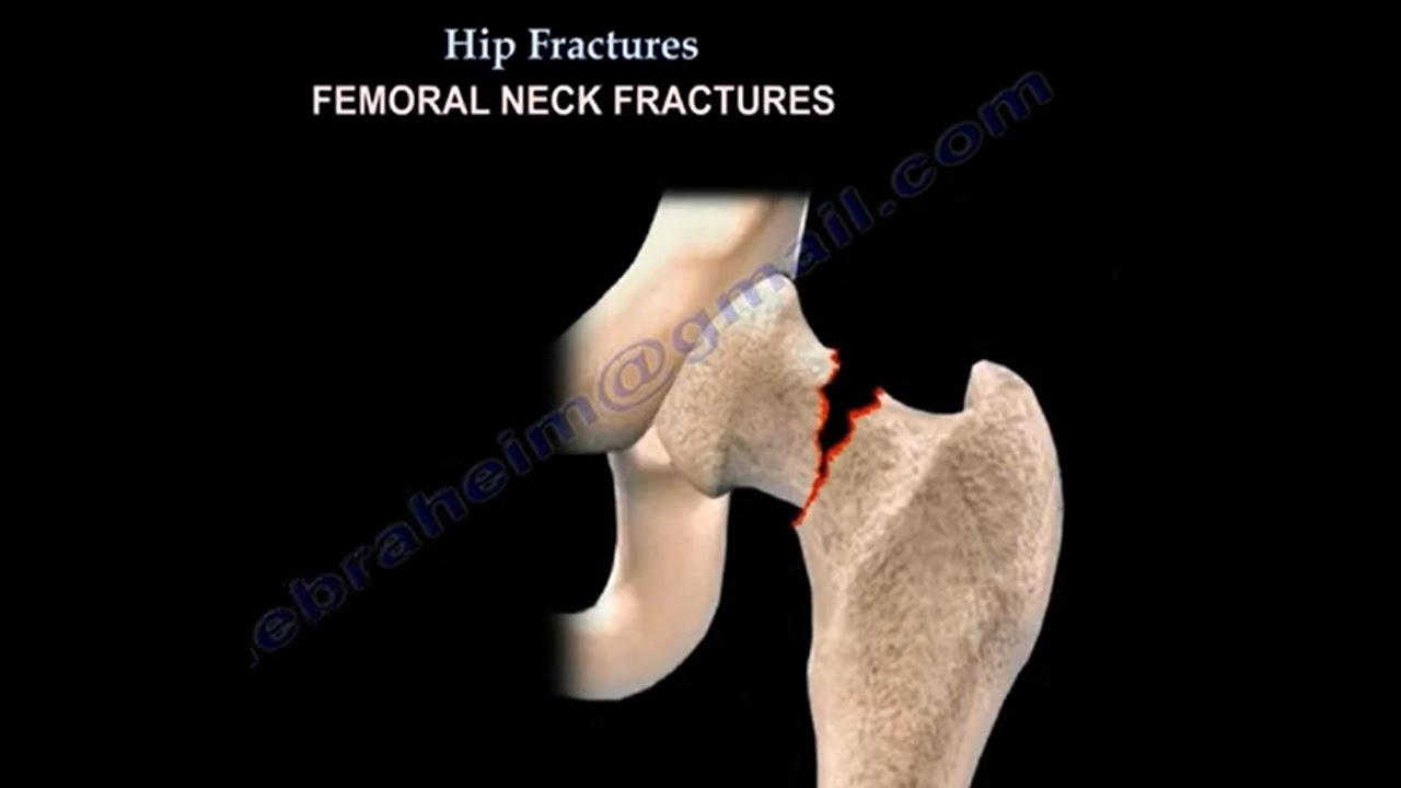 Hip Fractures types ,classification  and treatment