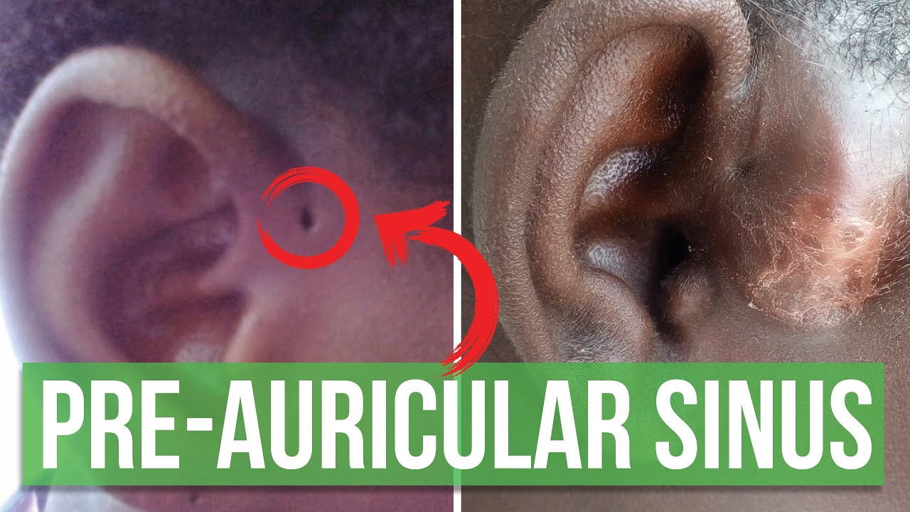 Explaining a preauricular sinus (a tiny hole in front of the ear) & what happens when it's infected