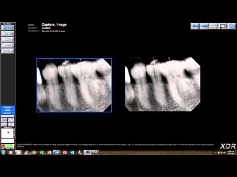 XDR Clinical Minute: Episode 2 - Implementing the ALARA Principle