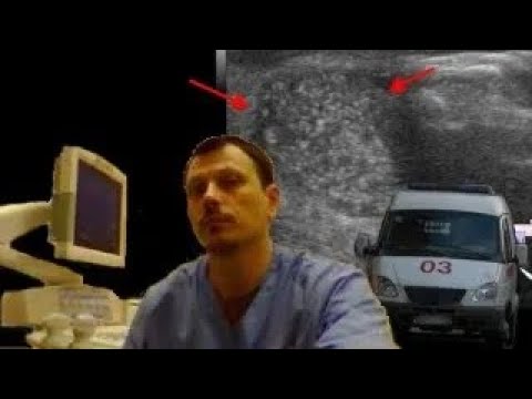 Pediatric Scrotal ultrasound - Testicular microlithiasis