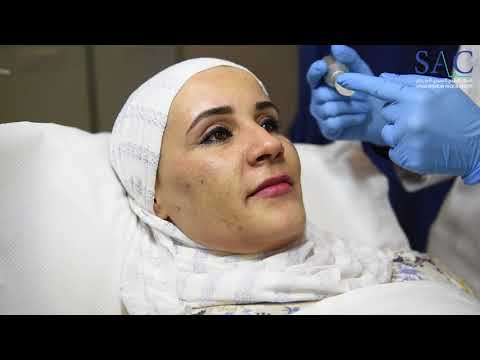 المركز السوري الامريكي | علاج الكلف والتصبغات