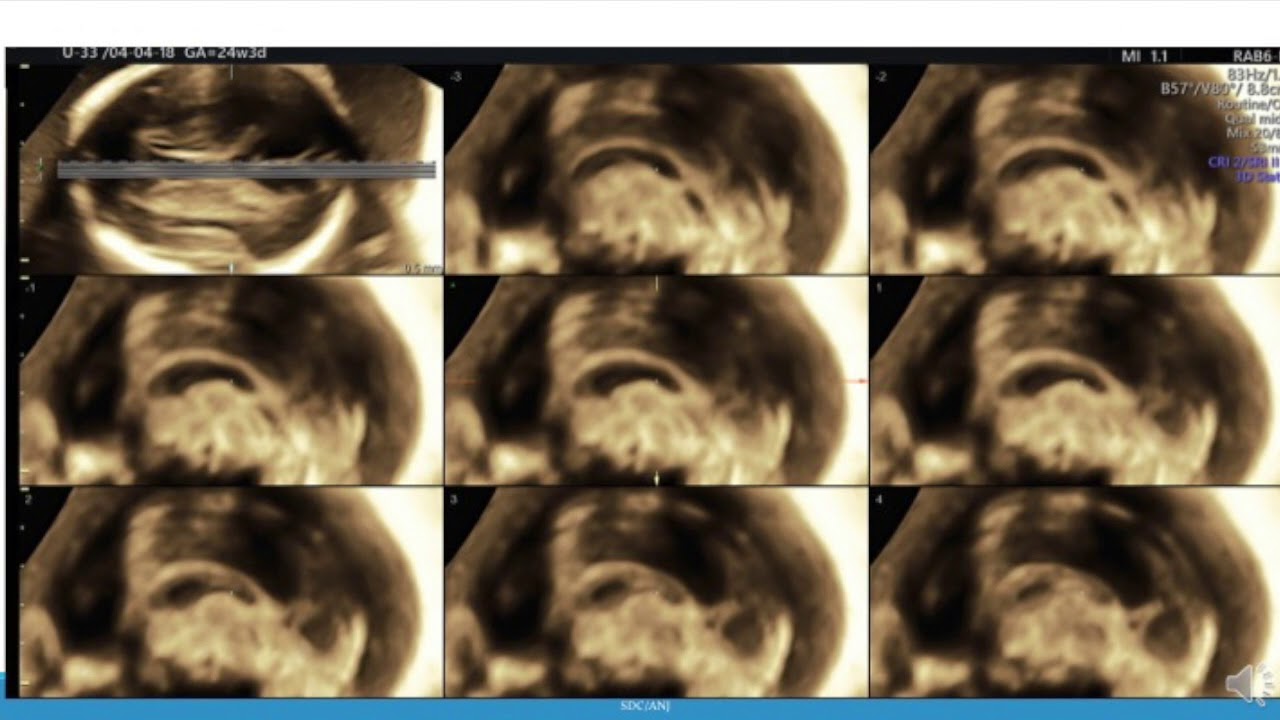TMT: FETAL IMAGING: CAVUM SEPTUM PELLUCIDUM