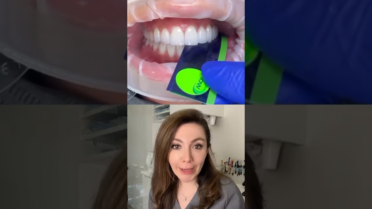 What Happens If You Don’t Get Your Bite Adjusted After Veneers?!