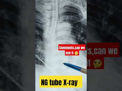 NG tube positioning || coiled tube | #nasogastrictube #tubing #xrays #chestxray #shorts #viral
