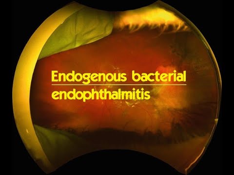 Endogenous bacterial endophthalmitis #KanskiSeries #2022