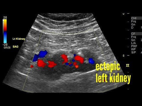 Ectopic kidney with malrotation, ultrasound and color, spectral Doppler video