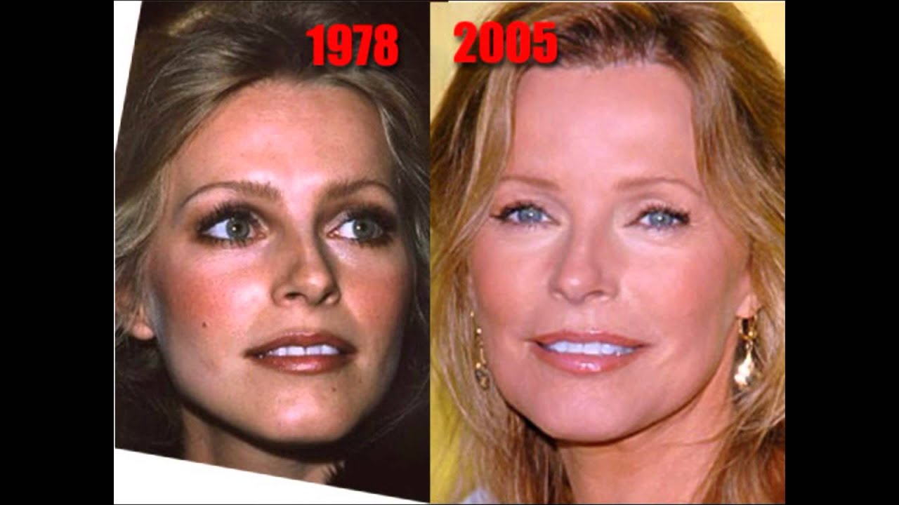 Cheryl Ladd Plastic Surgery