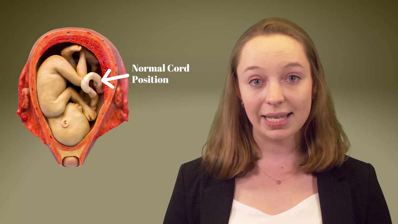 Umbilical Cord Prolapse