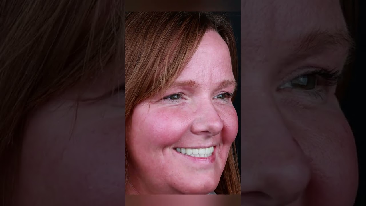 The power of dental imaplants  #beforeandafter #transformation #smilemakeover