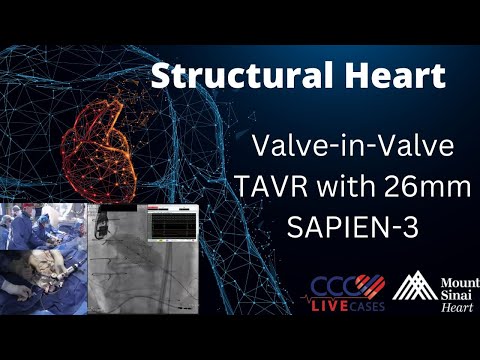 Valve-in-Valve TAVR with 26mm SAPIEN-3 - March 2019