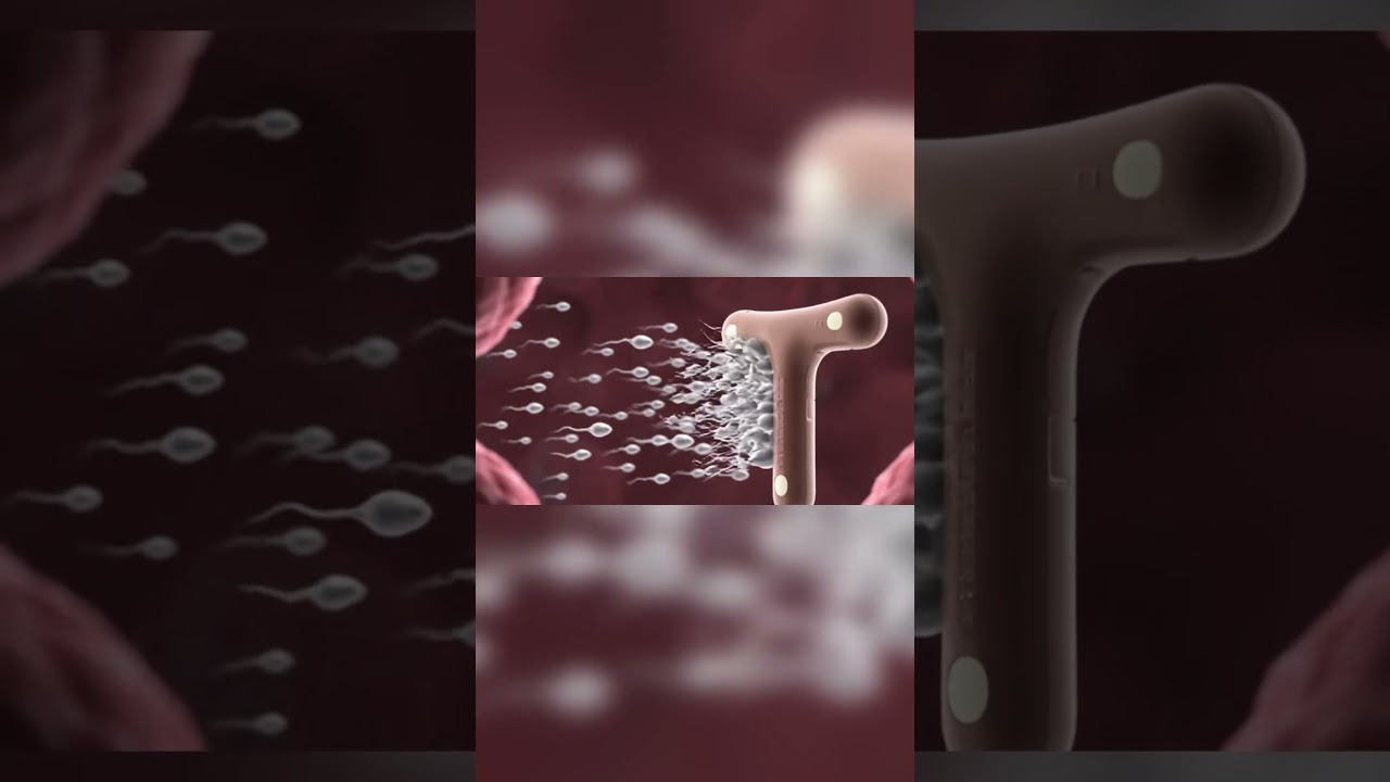 Illustration of how IUD works #FamilyPlanning #BirthControl #Contraception #PregnancyPrevention