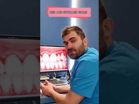 Symptoms of gingivitis