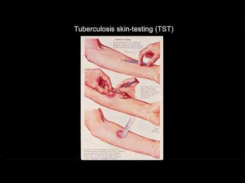 “Update: Lung Disease for Non-tuberculosis Mycobacteria” by Richard F. Silver, MD