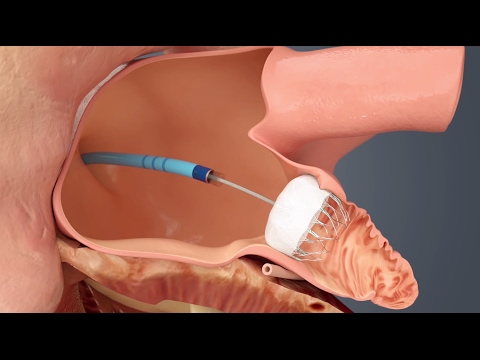 Watchman Implant Device for AFib