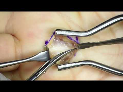 Locked Metacarpophalangeal Joint – Open Reduction