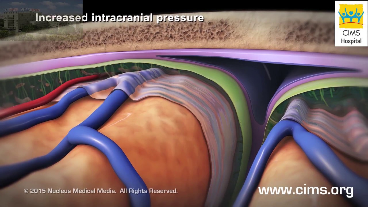 Craniotomy and Craniectomy - CIMS Hospital