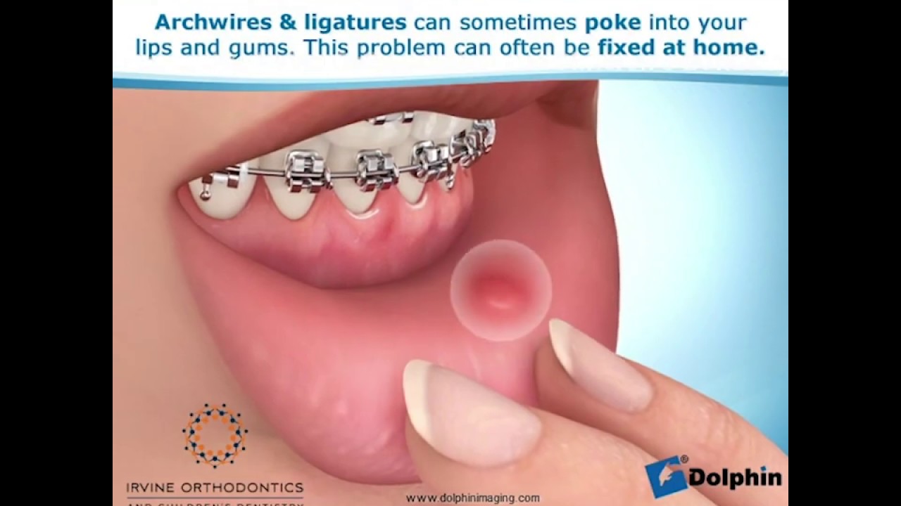 How to take care of most Orthodontic emergencies at home