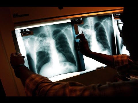 What is TB?