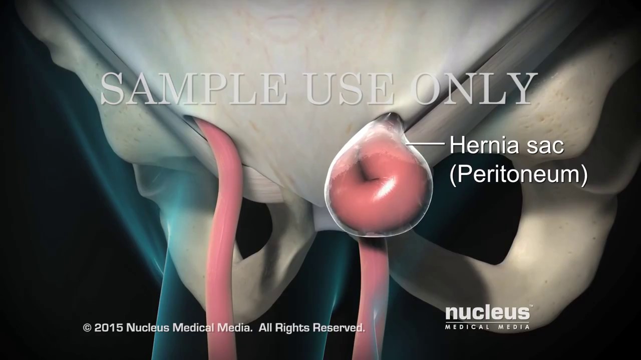 Técnica TEP: Hernia inguinal laparoscópica