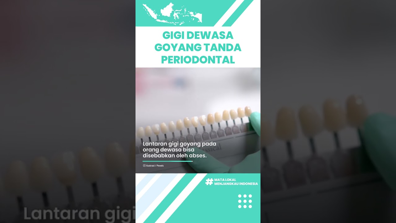 Jangan Asal Cabut, Gigi Goyang Dewasa Bisa Jadi Penyakit Periodontal, Ini Kata Dokter Ahli ...