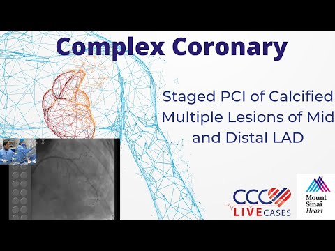 Staged PCI of Calcified Multiple Lesions of Mid and Distal LAD - February 17, 2015 Webcast