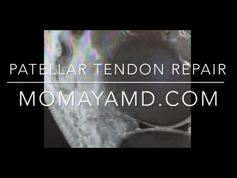 Patellar Tendon Repair