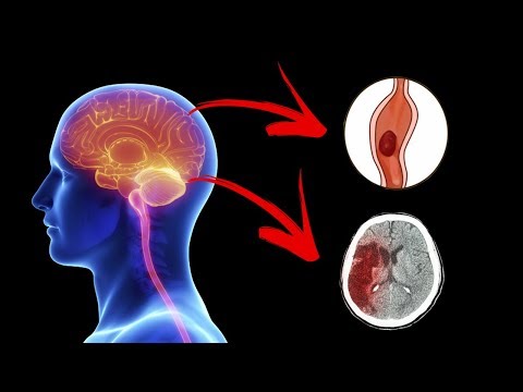 5 Warning Signs of a Stroke you should Never Ignore