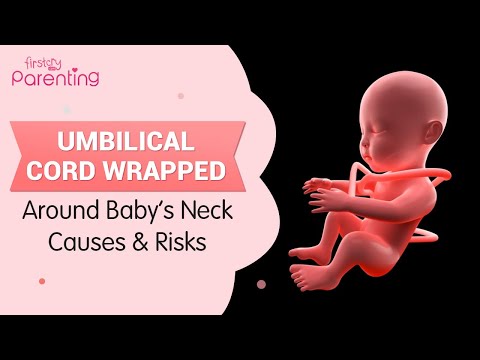 Umbilical Cord Around Baby's Neck (Nuchal Cord) - Causes, Risks and Prevention