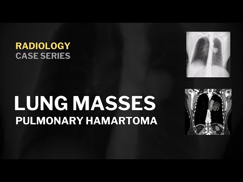 Pulmonary hamartoma | Radiology | truefisp