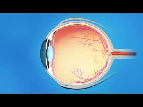 Laser Trabeculoplasty for Glaucoma