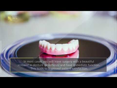The All-on-4® treatment by Aria Dental Implant Center in Phoenix and Dr. Joe Mehranfar.