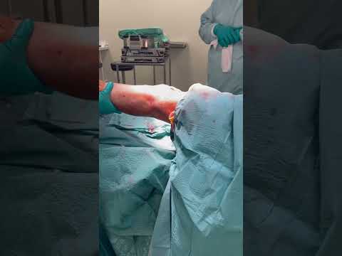 Immediate post-operative range of motion in knee replacement- what can be achieved?