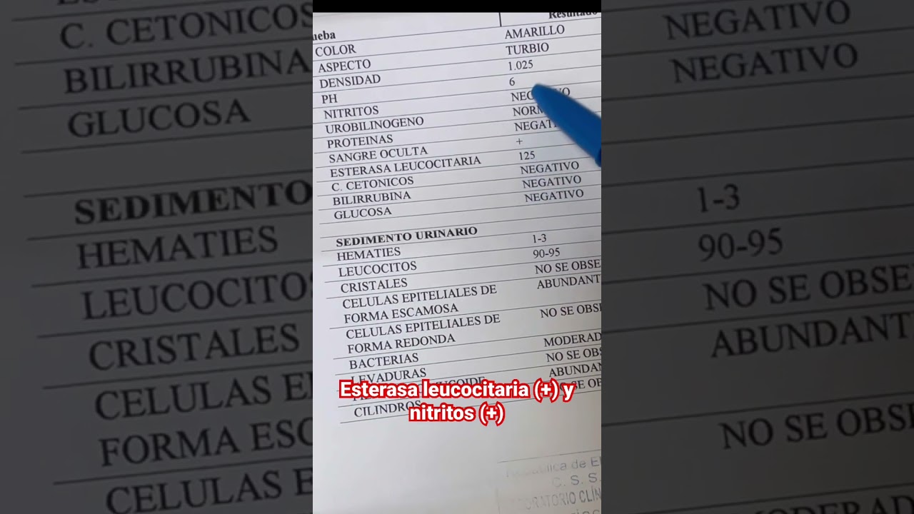 Criteria for UTI in the General Urine Test