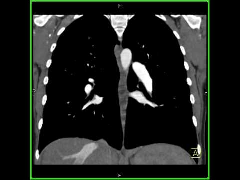 Lung Anatomy: Pulmonary Embolism (Coronal View)