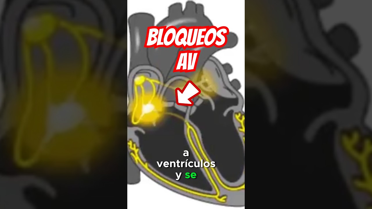 Bloqueos aurículo ventriculares 🫀 #emergency