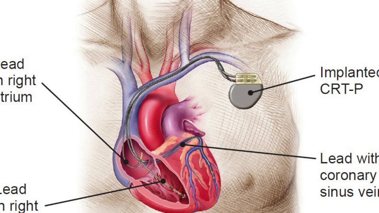 PACEMAKERS: PACE CARDIOLOGY
