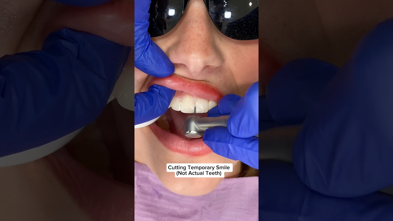 Limited front four veneers 🦷 #dentalveneers #veneers #porcelainveneers #frontteeth