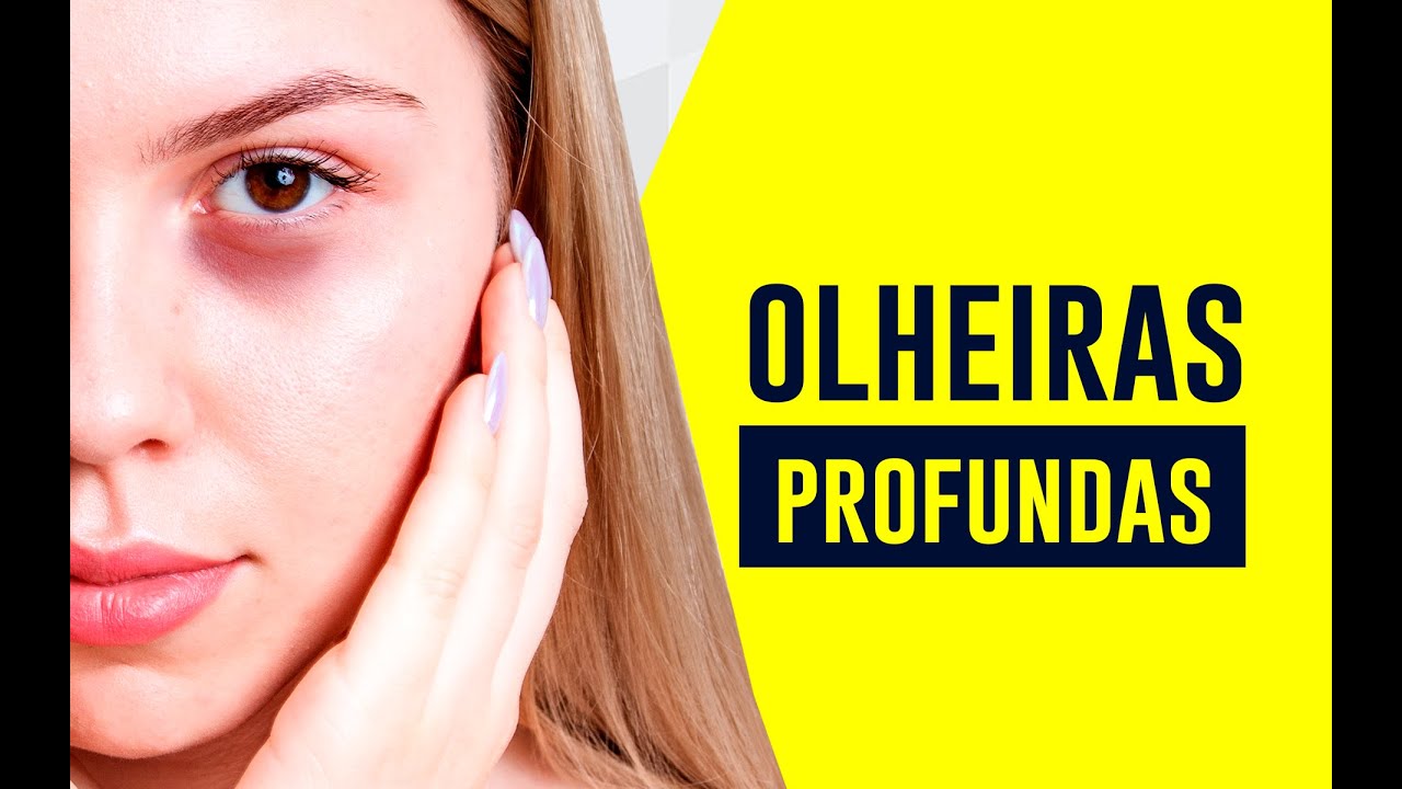 OLHEIRAS PROFUNDAS, o que fazer? | Dr Vitor Erlacher