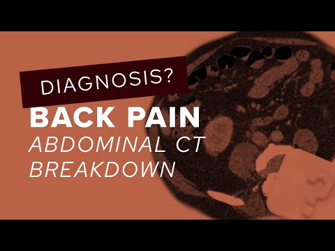 Abdominal CT breakdown: assessing back pain